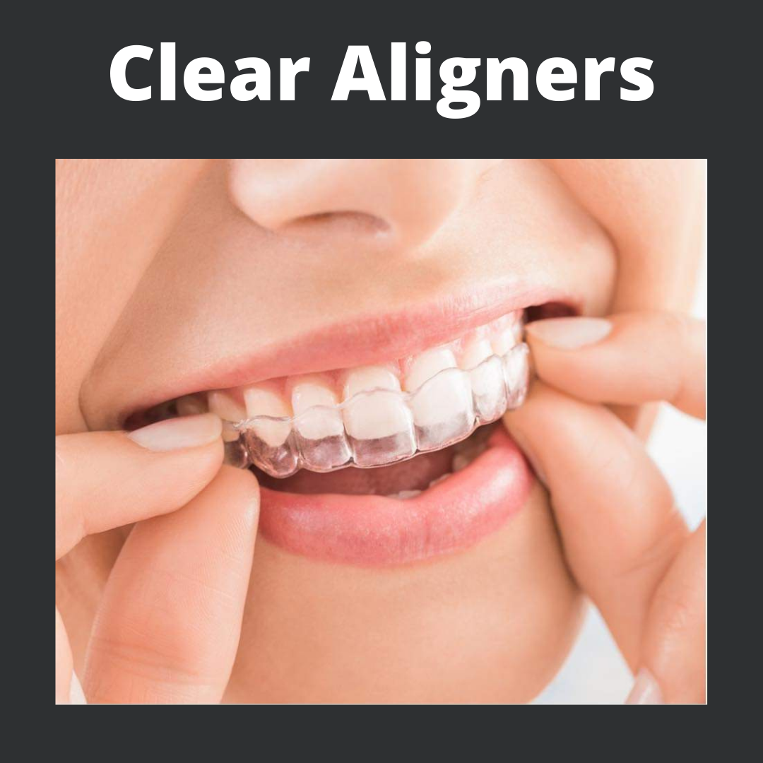 CLEAR ALIGNERS- An alternative to Traditional Braces - Shubham Dental ...